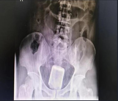 Rectal Foreign Body Removal Cpt